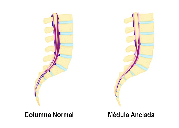 Médula anclada